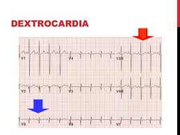 .: Dextrocardia: síndrome del corazón al revés.