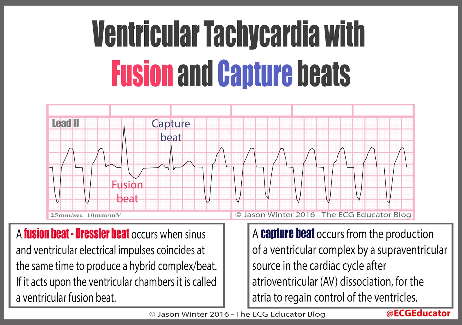 ECG Educator Blog : Is it VT?