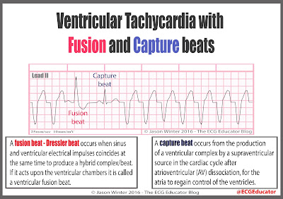 ECG Educator Blog : Is it VT?