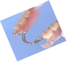 a.ionta: Prótese Estética Flexível com Armação PPR