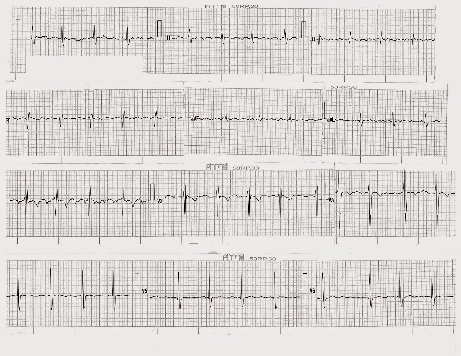 Electrocardiogramas HOK: Paciente masculino con TEP crónico e ...