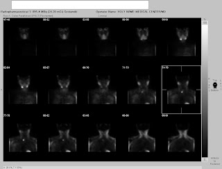 Nuclear Medicine Technology Program: Abnormal Parathyroid Scan