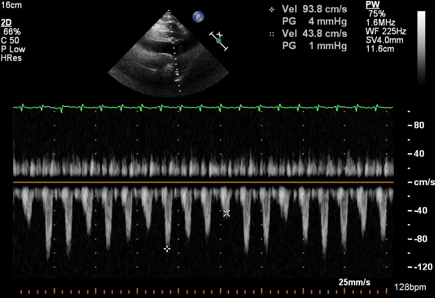 Pedi cardiology: Echo features of tamponade