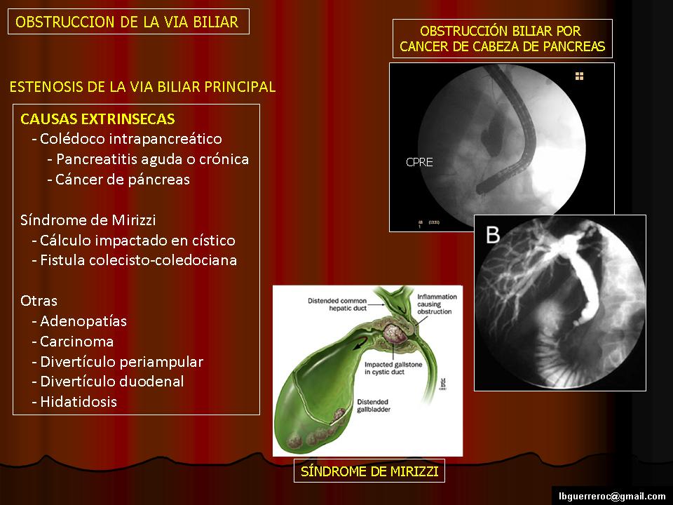 Dr. Luis B. GUERRERO CABRERA: ESTENOSIS de la VIA BILIAR PRINCIPAL