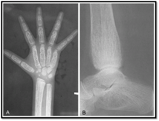 RADIOLOGY IMAGE SPOTTERS Thalassemia radiology-image-spotters-thalassemia