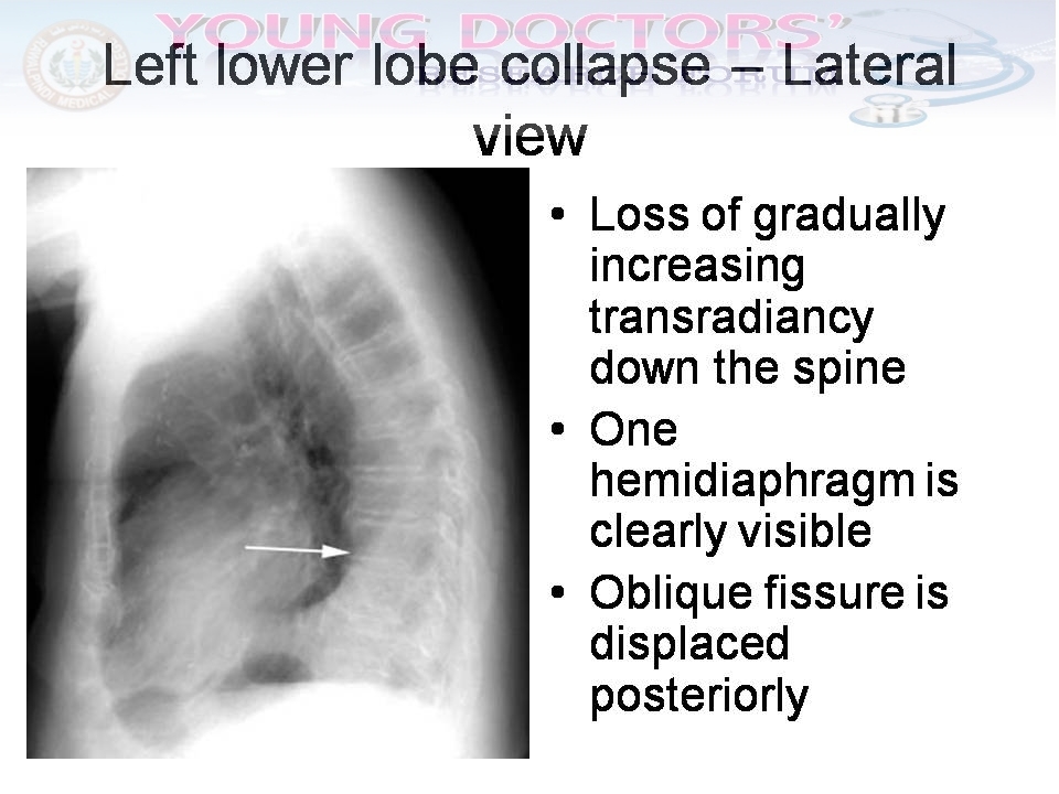 Quick Diagnosis Of The Chest X-Rays (CXR) ~ YOUNG DOCTORS' RESEARCH FORUM
