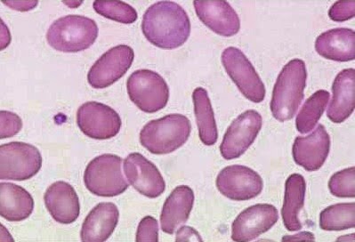 FICHERO DE HEMATOLOGIA 2015: Patologías de los eritrocitos ANEMIAS