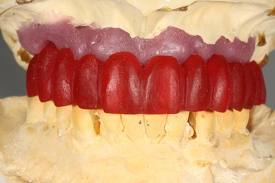 Prótesis Fija II: RESINA CALCINABLE (DURALAY)