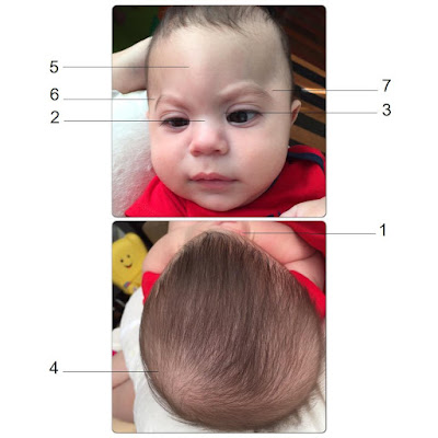 Nossa jornada com a craniossinostose: As 7 características da ...