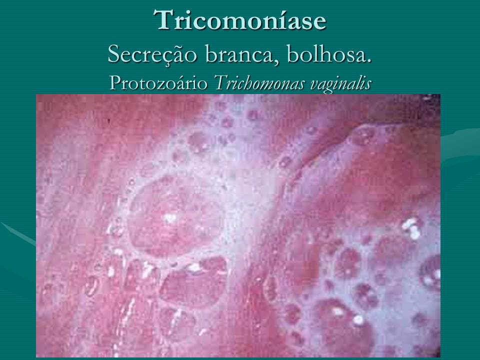 BIOLOGIA COM A PROFESSORA EDILENE: IST - INFECÇÕES SEXUALMENTE ...