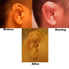 Sportygeia Medicina del Deporte y Fisioterapia.: OREJAS DE COLIFLOR EN ...