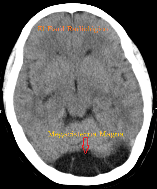 El Baúl Radiológico: ASPECTO DE LA CISTERNA MAGNA EN TOMOGRAFÍA ...