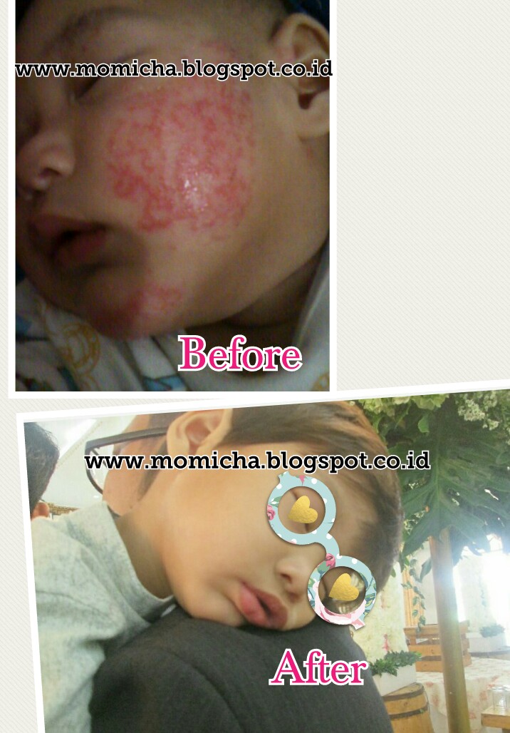 Momicha: Ruam Pipi Pada Bayi (part 2), "Dermatitis Atopi"
