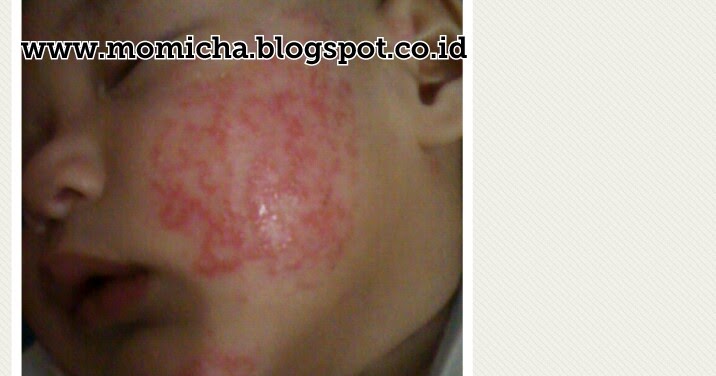 Momicha: Ruam Pipi Pada Bayi (part 2), "Dermatitis Atopi"