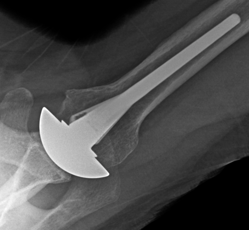 UW Shoulder and Elbow Academy: Ream and Run - state of the art