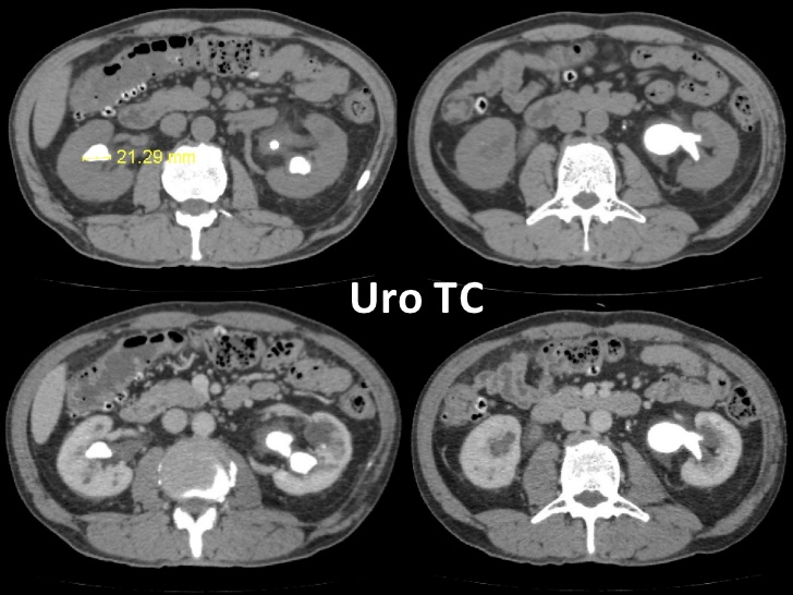 El problema de la Dosis de radiación en la URO TC (por Miguel Ángel de ...