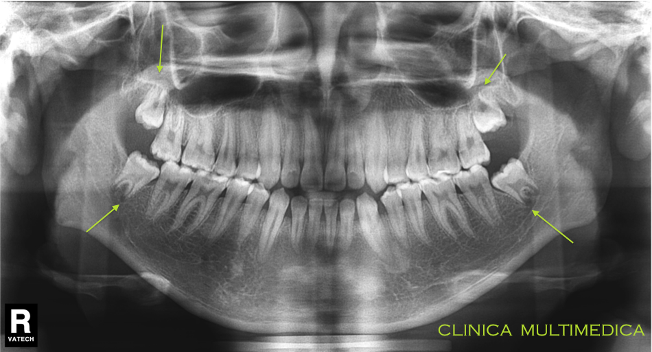 Odontología - Elsa & Asociados: Tercer molar o molar del juicio.