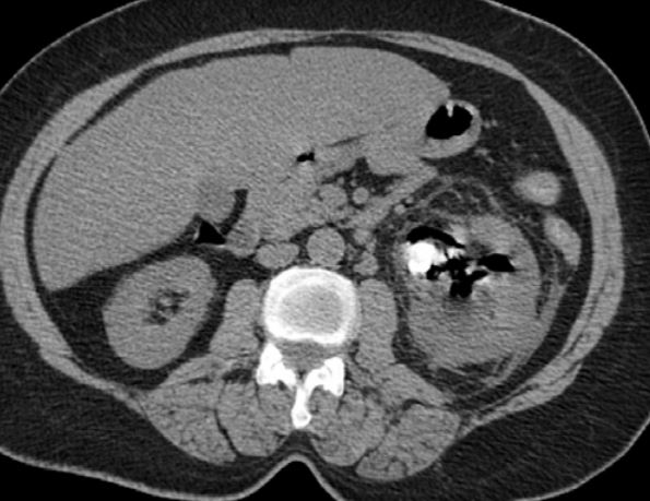 Emphysematous pyelonephritis - Review