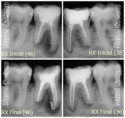 Endodontia Avançada: 2011