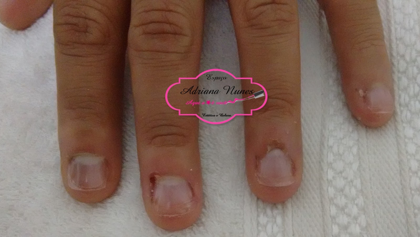 Espaço Adriana Nunes : UNHAS ROÍDAS. NUNCA MAIS!