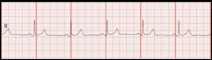 Float Nurse: Practice EKG Rhythm Strips 121