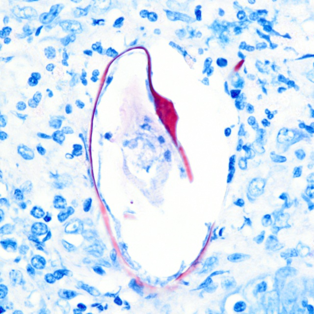 Positive staining of Schistosoma mansoni eggs