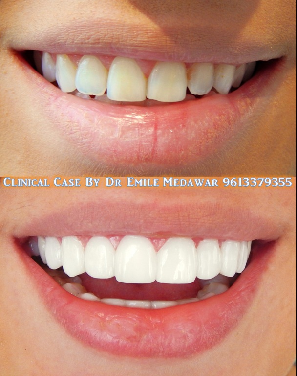Teeth Hollywood Smile, Dr Emile Medawar, 00 961 3 379355 : May 2015