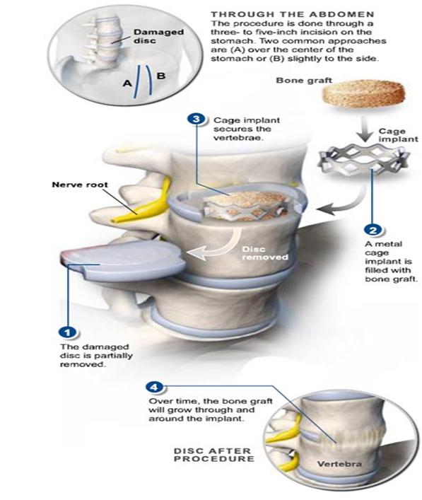Life After ALIF: What is an ALIF?