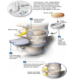Life After ALIF: What is an ALIF?