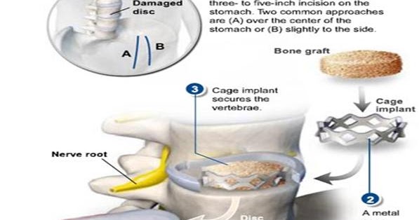 Life After ALIF: What is an ALIF?