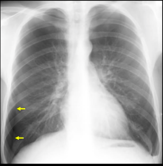 EM Didactic: Deep Sulcus Sign - Pneumothorax