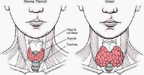 GOITRE (ENLARGED THYROID GLAND): CLASSES, CAUSES, SIGNS AND SYMPTOMS ...