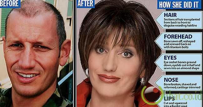 7 Wonders of The World: 7 Men Enthusiast Plastic Surgery