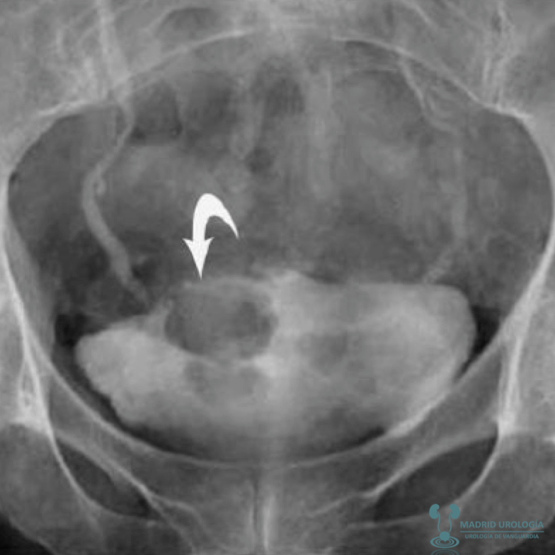 Madrid Urología: Cáncer de Vejiga. Diagnóstico - Estudio. MU. Capítulo ...