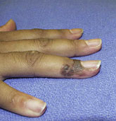 doookin: Finger Cancer From skin cancer