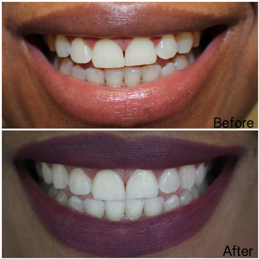 Whitening My Teeth At Home With Smile Brilliant + Giveaway — Patty's Kloset