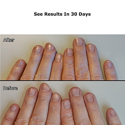 How To Stop Nail Biting - TOP 5 DIY