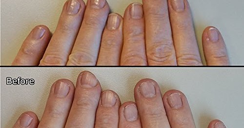 How To Stop Nail Biting - TOP 5 DIY