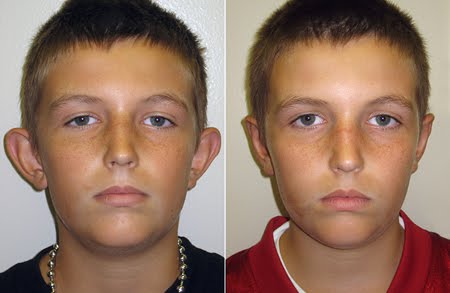 Ear Reshaping: Otoplasty – The MedSchool Project