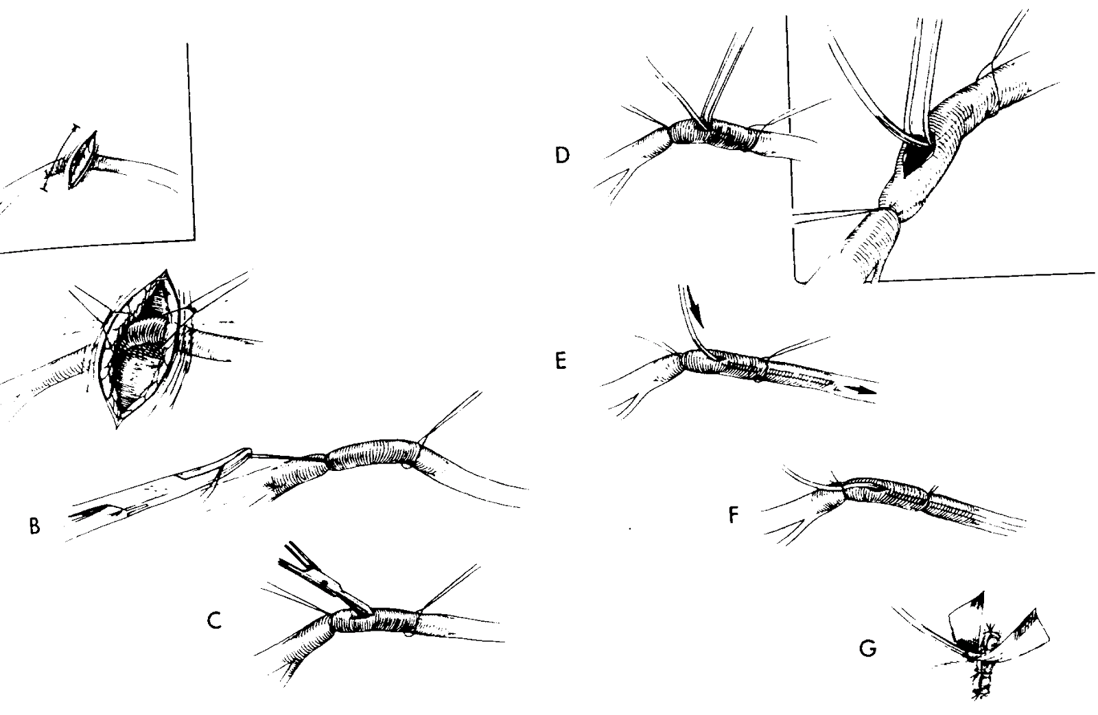 Canalización De Vías Venosas