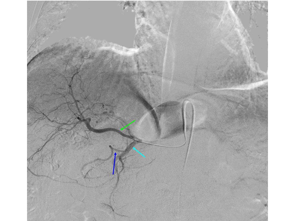 The Pump and the Tubes: The Retroportal Artery