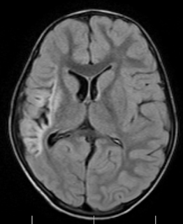 Rasmussen’s encephalitis-MRI - Sumer's Radiology Blog