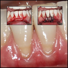 Pyorrhoea : An overview