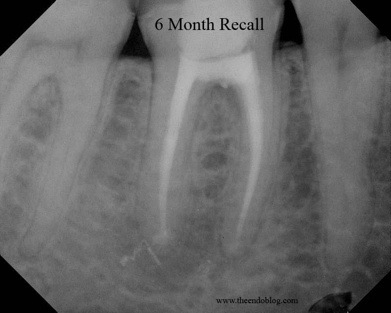 The Endo Blog Microscopes And Management Of Root Canal Perforation