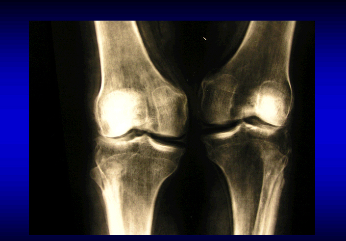 Rheumatologe: Arthrose / Definition, Diagnose und Dilemma