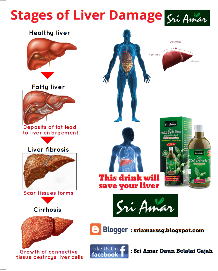 SRI AMAR SABAH SNAKE GRASS: FATTY LIVER