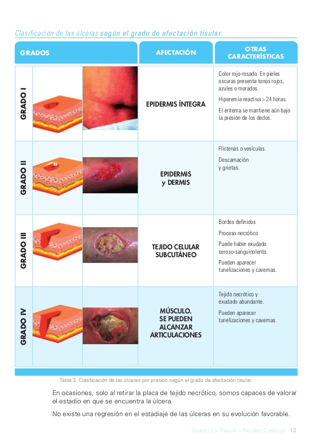 Ulceras por decubito: proceso de ulceras por decubito