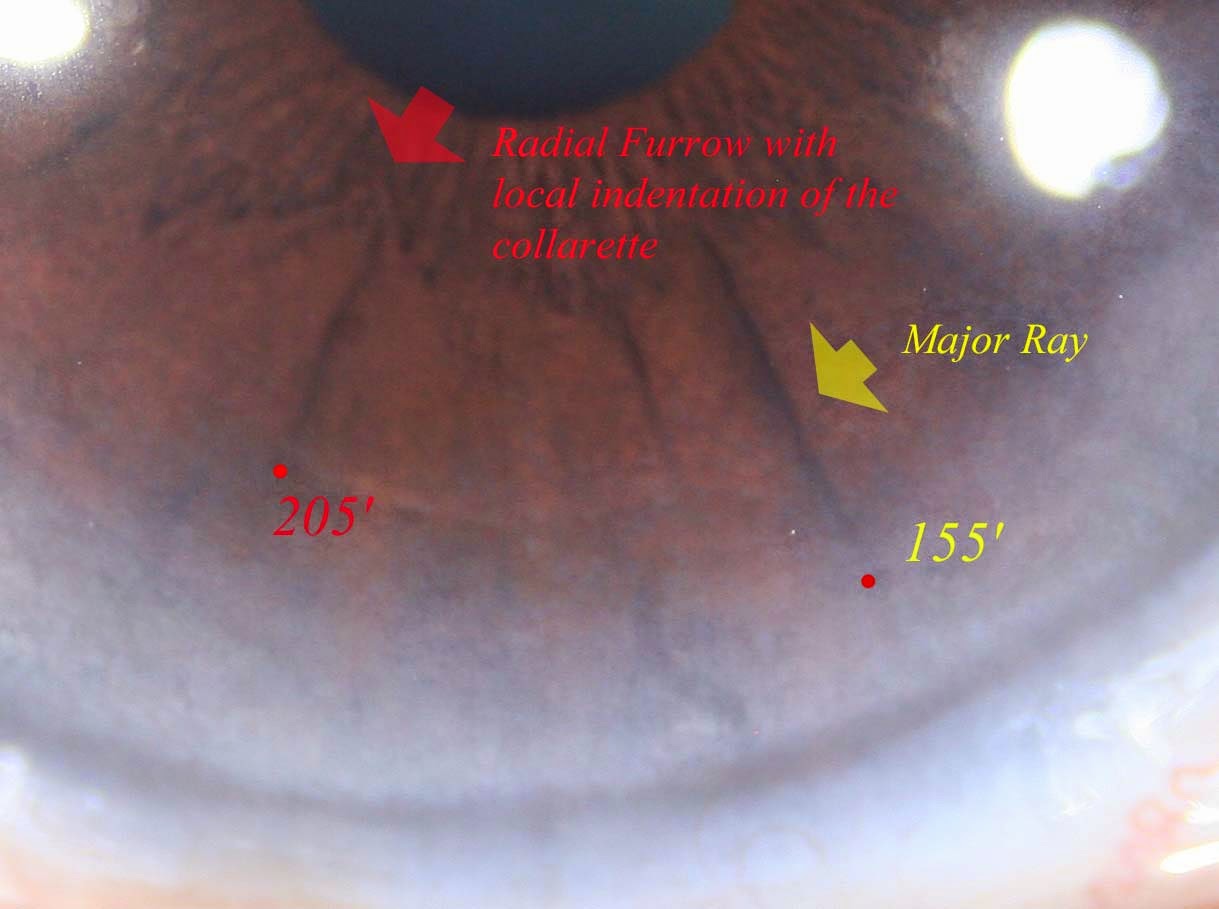 Modern & Multidimensional Iridology: Schwalbe's Contraction Furrows ...