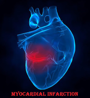 Apa Itu Infark miokard?? - ARTI LENGKAP Myocardial Infarction | Sayangi ...