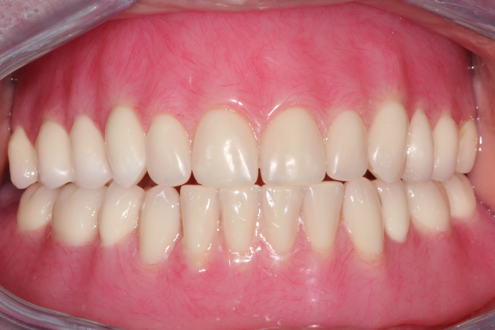 Boise Idaho Prosthodontics: Maxillary Complete Denture and Mandibular ...